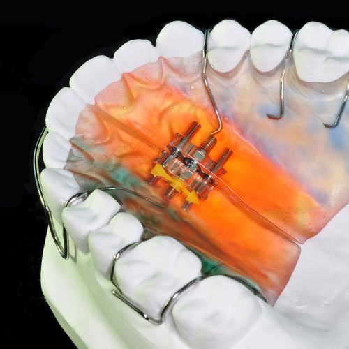 Ortho Appliances – Sharp Dental Laboratory